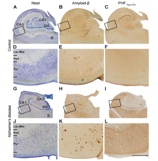 Brain：阿尔兹海默症海马CA1区的突触组织的三维分析｜导读80期_腾讯新闻