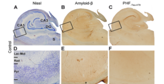 Brain：阿尔兹海默症海马CA1区的突触组织的三维分析｜导读80期_腾讯新闻