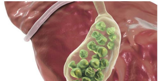 CA199升高数倍＝癌症？千万别忽视这5种可能！_腾讯新闻