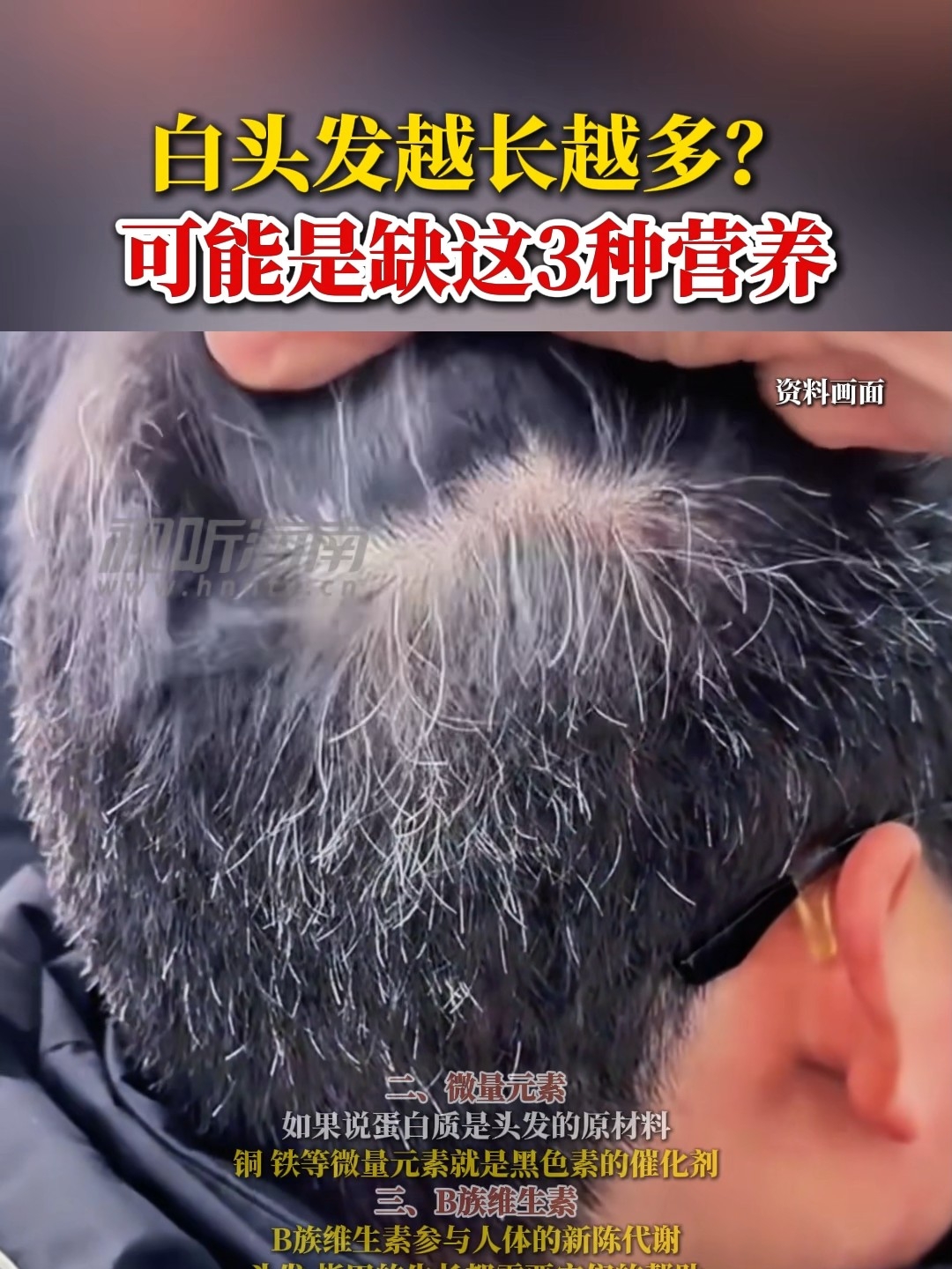 白头发越长越多？ 可能是缺这3种营养_腾讯新闻