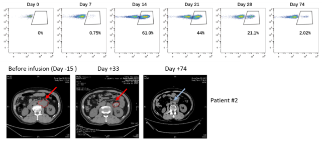 上海交大发现新型CAR-T疗法，有效率达100％，有望攻克实体瘤_腾讯新闻