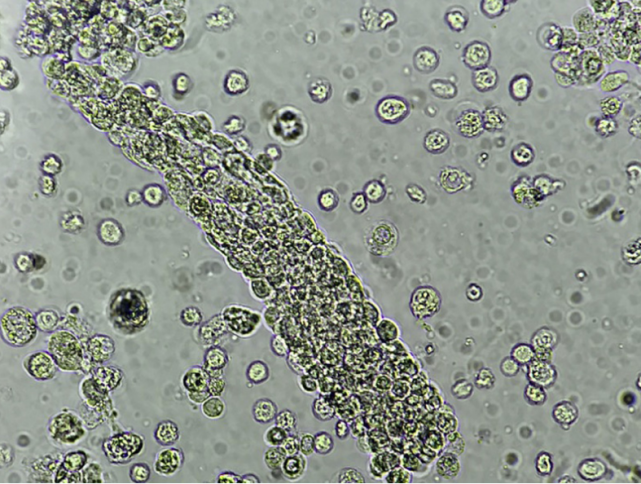 诱发AKI的隐匿杀手：如何诊断急性小管间质性肾炎？_腾讯新闻