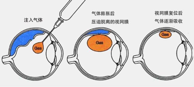 熬夜刷手机会导致视网膜脱落？更需要注意的是这个_腾讯新闻