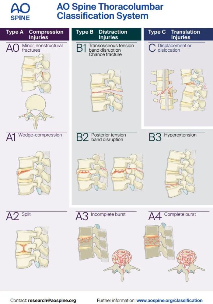 骨科精读｜一文读懂胸腰椎骨折的AO分型与TLICS、载荷分享评分！_腾讯新闻