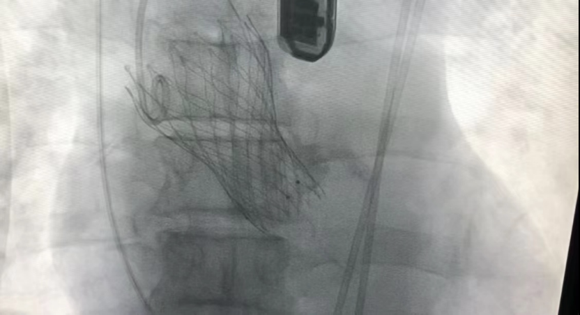 深圳市中医院完成高难度TAVR手术_腾讯新闻