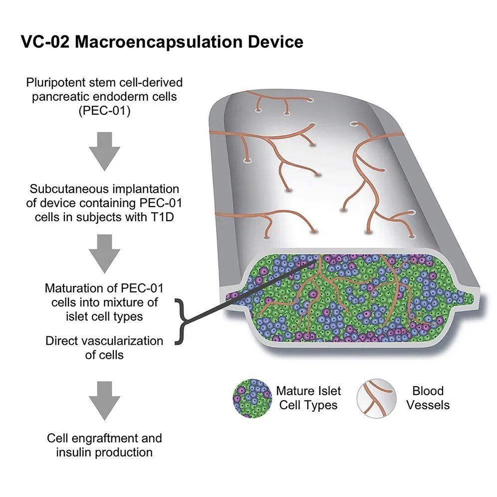 胰岛细胞再生「老兵」ViaCyte最新临床试验数据差强人意，专家称问题可能出在前体细胞_腾讯新闻