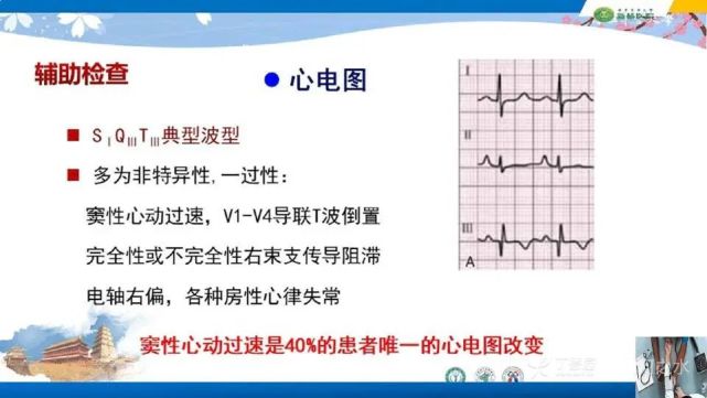 临床干货｜一文读懂肺栓塞的诊断与治疗_腾讯新闻