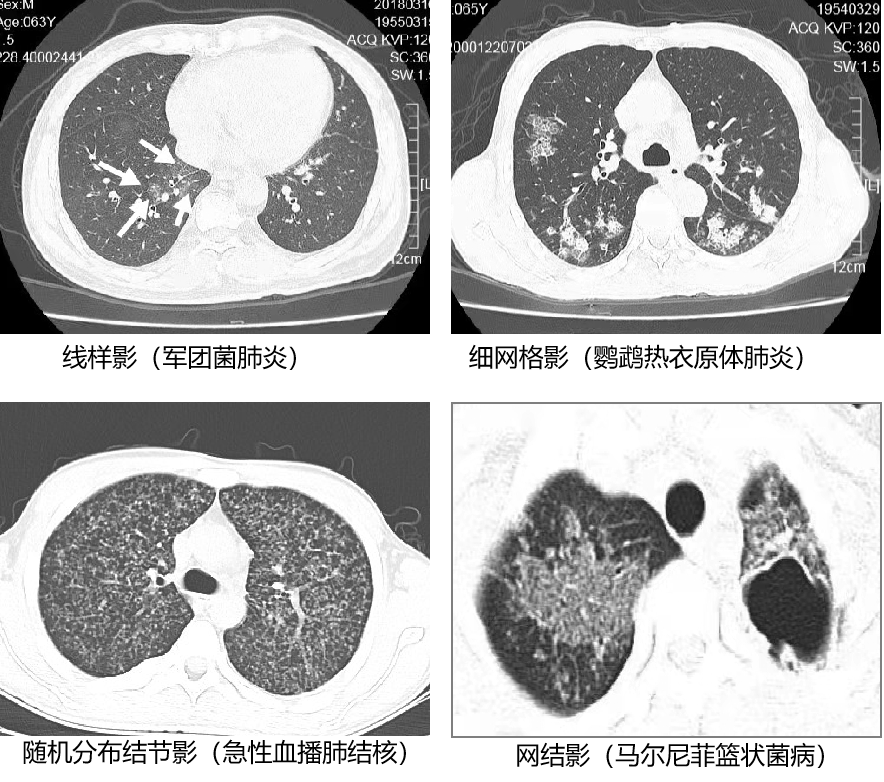 想通过肺 CT 表现判断致病菌？先掌握这 3 种肺炎是关键！_腾讯新闻