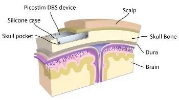 世界最小的 DBS 大脑植入物设备可逆转帕金森的症状｜CyberDaily_腾讯新闻