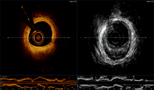 国产首个，“IVUS、OCT二合一”血管内成像设备获批_腾讯新闻