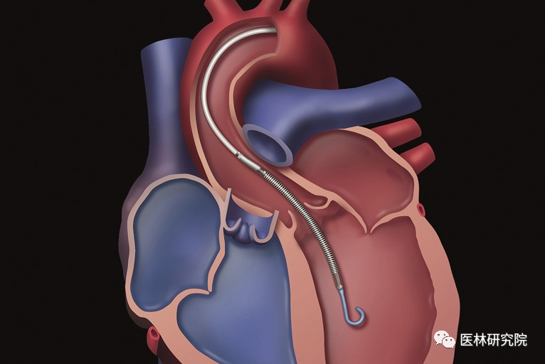 pVAD进展：Supira小型泵首例人体应用，Impella拓展心源性休克适应症_腾讯新闻