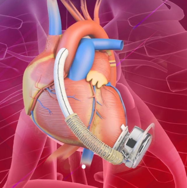 脱口秀演员植入磁悬浮人工心脏“重获新生”，采用中国自主研发的植入式心室辅助装置系统_腾讯新闻
