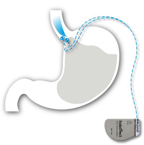 不吃药就能治疗胃食管反流病、虚拟患者引擎助力候选药物临床转化……｜一周科技盘点_腾讯新闻