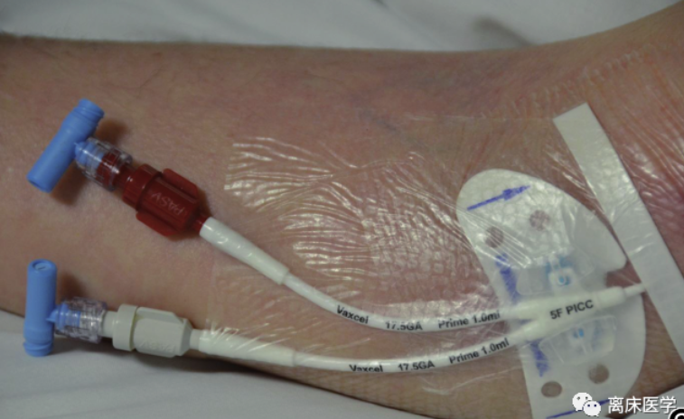留置针、CVC、PICC、输液港有什么区别？5 种静脉通路大对比_腾讯新闻