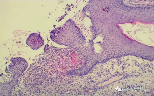 病例解读：同为PSTPIP1基因突变，症状与PAPA相近的罕见病，PAPASH综合征_腾讯新闻