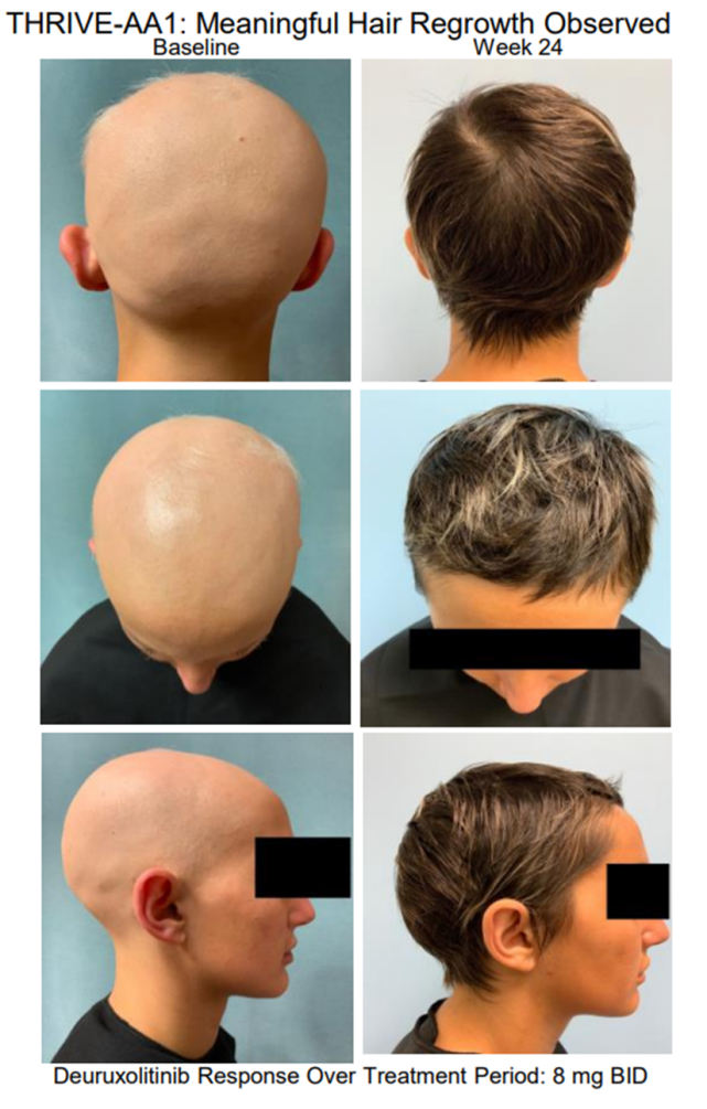 速递｜显著改善毛发再生，5.76亿美元助力潜在“best-in-class”疗法上市_腾讯新闻