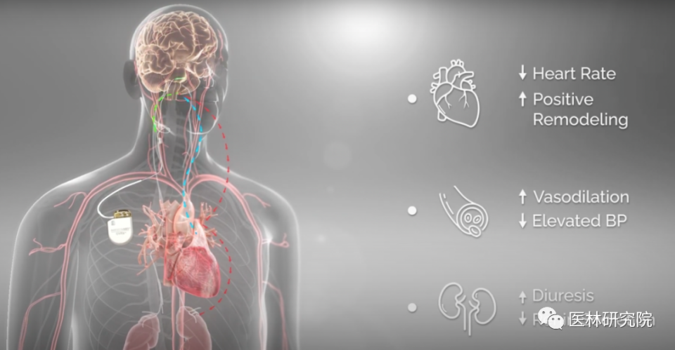 Barostim：颈动脉窦刺激，有效改善重度心衰_腾讯新闻