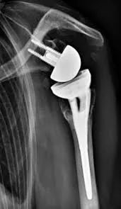 首个，热解碳肱骨头获批FDA_腾讯新闻