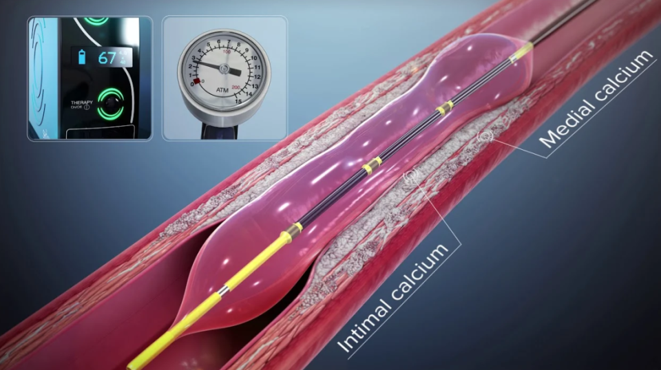 720亿，心血管巨头的反击_腾讯新闻