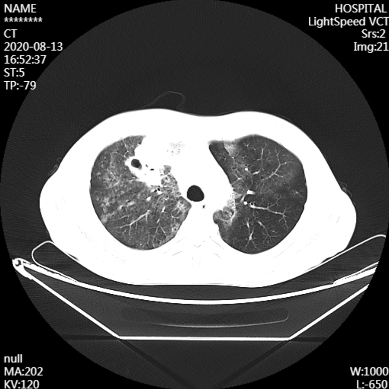 诊知灼见丨胸部CT显示双肺弥漫性间质性病变，提示肺泡蛋白沉积症？该如何诊治？_腾讯新闻