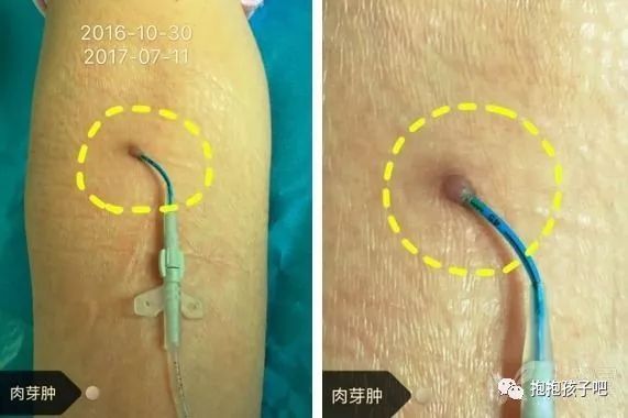 太实用了！超全的 PICC 常见问题及处理方法，值得珍藏_腾讯新闻