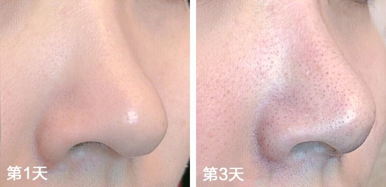 黑头千万别挤！用这招清掉10年黑头，从此黑头不爱长！