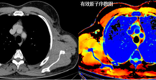 彩色CT，实现1＋1＞2效益！_腾讯新闻