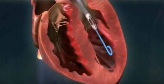 pVAD进展：Supira小型泵首例人体应用，Impella拓展心源性休克适应症_腾讯新闻