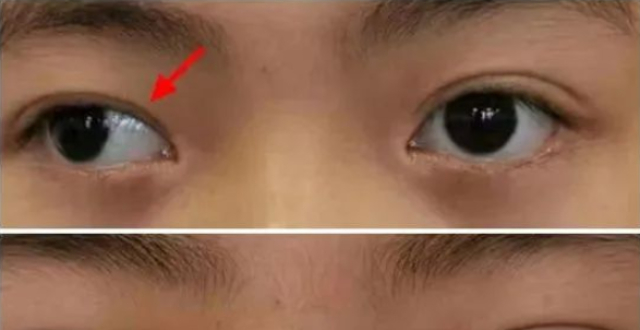 罹患罕见Helveston综合征，花季少女在湘雅常德医院改“斜”归正_腾讯新闻