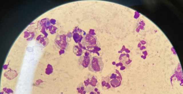 罕见的狼疮细胞-Rhupus综合征1例_腾讯新闻