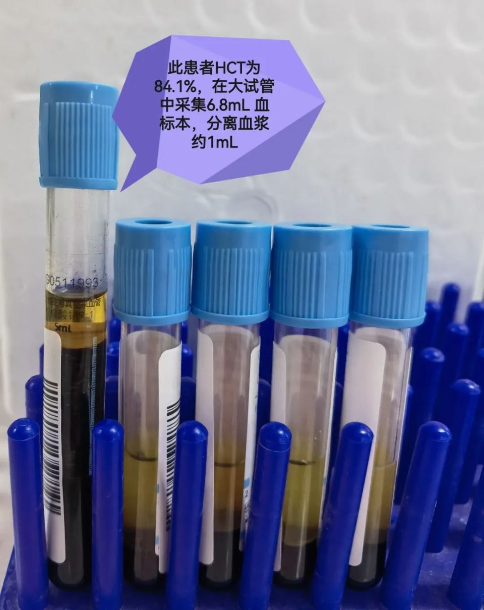 HCT＞0.55、HCT＞0.74患者凝血标本处理小技巧_腾讯新闻