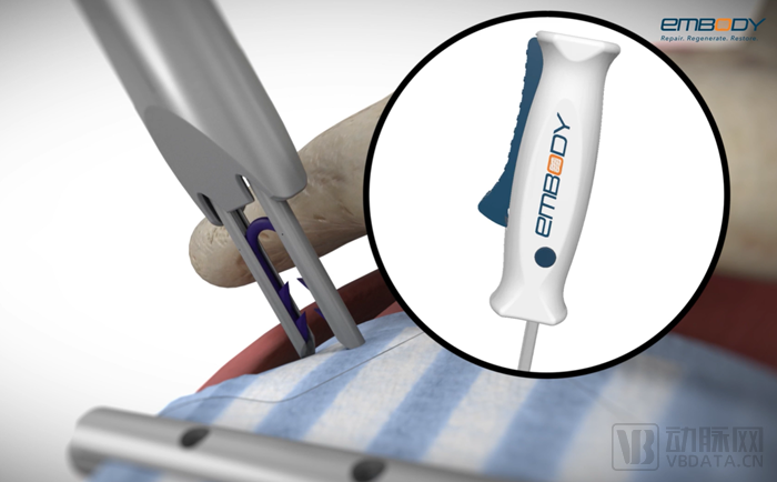 被捷迈邦美以2.75亿美元收购，这家创新械企的两款软组织修复产品已获FDA许可【海外案例】_腾讯新闻