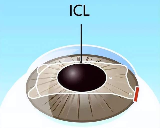 近视手术-ICL晶体植入手术流程全攻略来啦！近视朋友建议收藏_腾讯新闻