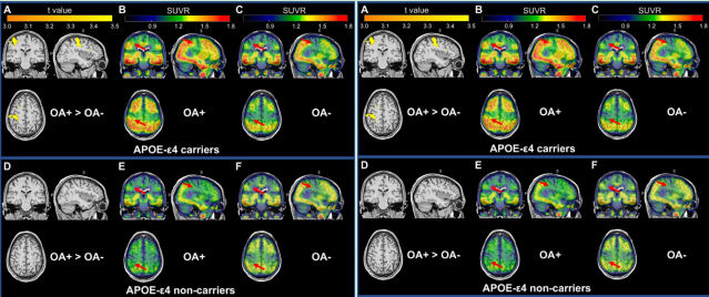 2023年AD研究大盘点：从19岁的AD患者研究再到5篇Cell封面论文_腾讯新闻