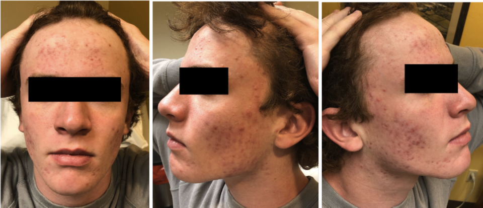 梅栏访 | 对话AOB Pharma公司总裁Todd Krueger：引领活菌药物治疗特应性皮炎的科研前沿_腾讯新闻