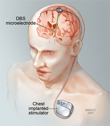 第一且唯一，美敦力最新一代DBS产品完成首批植入_腾讯新闻