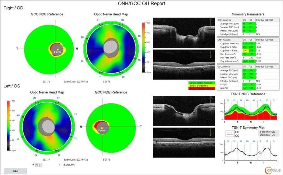 眼科OCT是眼部CT的一种吗？一文看懂眼科OCT到底是啥_腾讯新闻