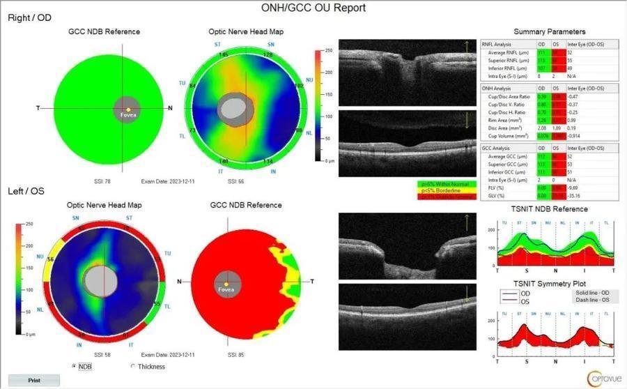 眼科OCT是眼部CT的一种吗？一文看懂眼科OCT到底是啥_腾讯新闻