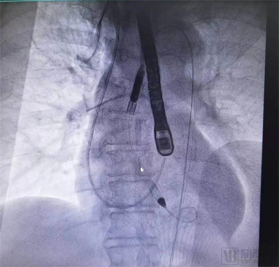 全国首例pVAD救治心源性休克患者手术取得成功，通灵仿生打破临床空白_腾讯新闻