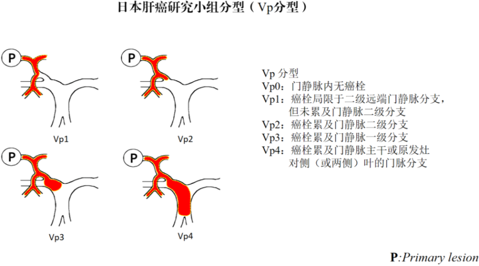 一文全览！肝癌合并 PVTT 的分型及治疗策略_腾讯新闻