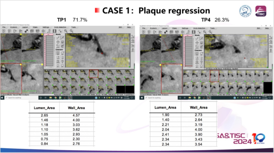 CSA&TISC 2024 | 王伊龙教授：基于高分辨率磁共振成像的瑞舒伐他汀治疗症状性大脑中动脉狭窄2年研究（REALM研究）_腾讯新闻