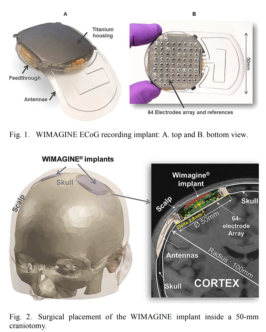 侵入式脑机接口，进展到哪一步了？ | 追问观察_腾讯新闻