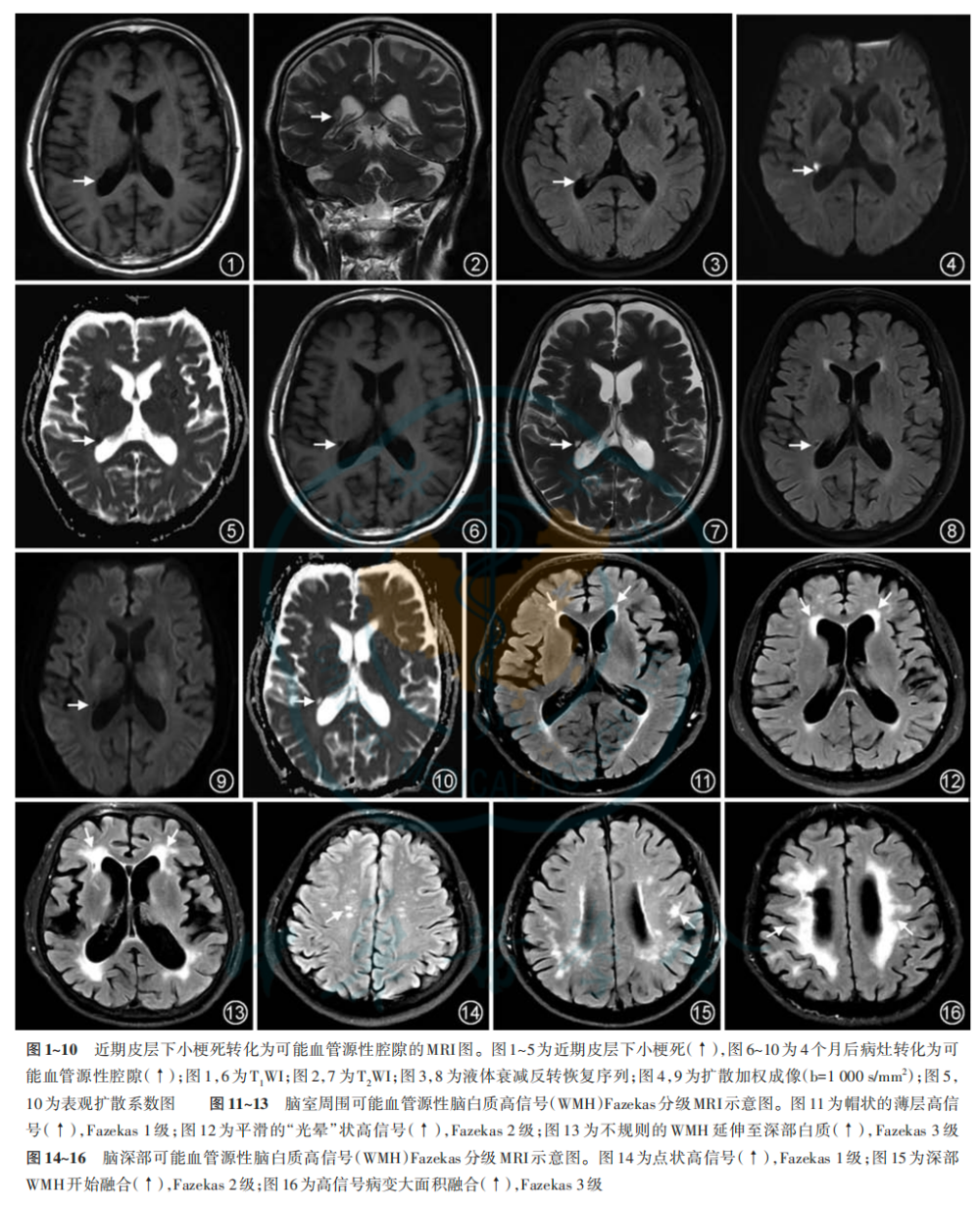 脑小血管病（CSVD）MRI规范化应用_腾讯新闻
