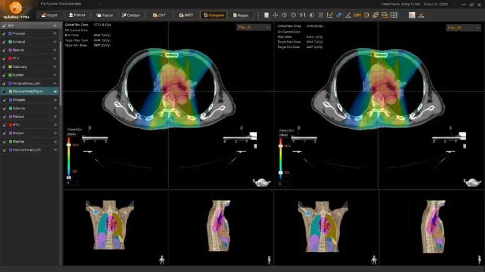 国产精准放疗高端设备获批上市_腾讯新闻