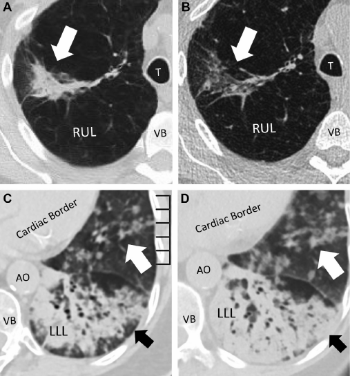 充分利用 Lung-RADS，做好肺结节筛查与应对_腾讯新闻