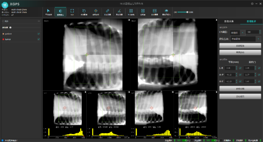 国产精准放疗高端设备获批上市_腾讯新闻