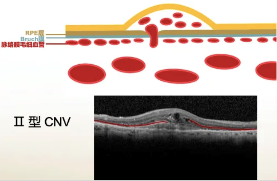 【眼底基础诊疗】wAMD新生血管解析_腾讯新闻