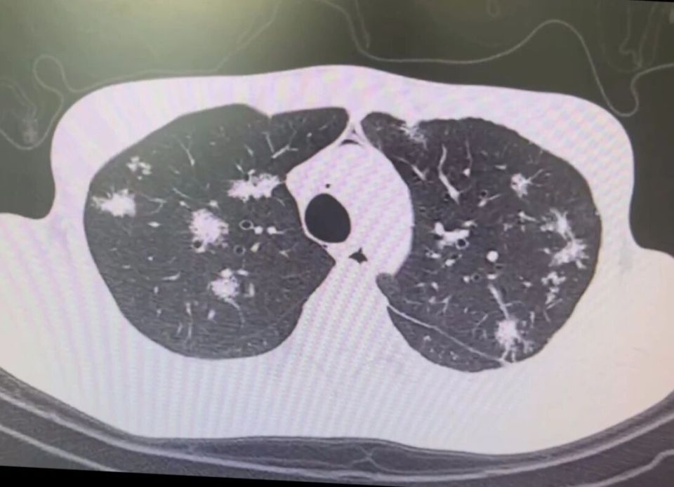 不要过于紧张！新增的肺部混杂磨玻璃结节没那么可怕_腾讯新闻