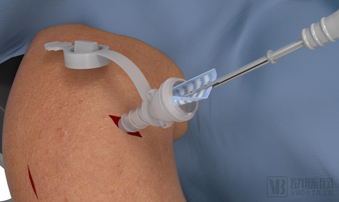 被捷迈邦美以2.75亿美元收购，这家创新械企的两款软组织修复产品已获FDA许可【海外案例】_腾讯新闻