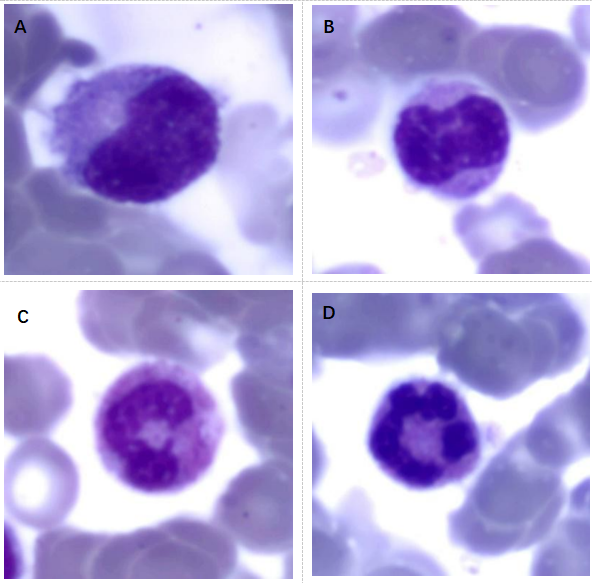 中性粒细胞升高你能想到几点原因？别只知道细菌感染！_腾讯新闻